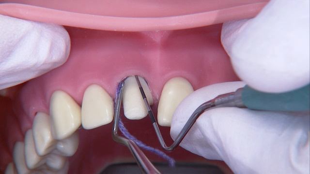 Ретракция десны и получение окончательного оттиска (2 часть, техника двойной тампонады пуповины)