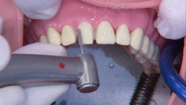 Препарирование переднего зуба (2 часть, аксиальная редукция, щечная)