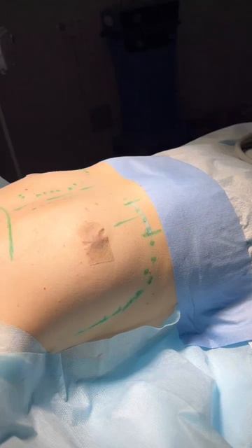 #увеличивающая_маммоплатика: сразу после операции