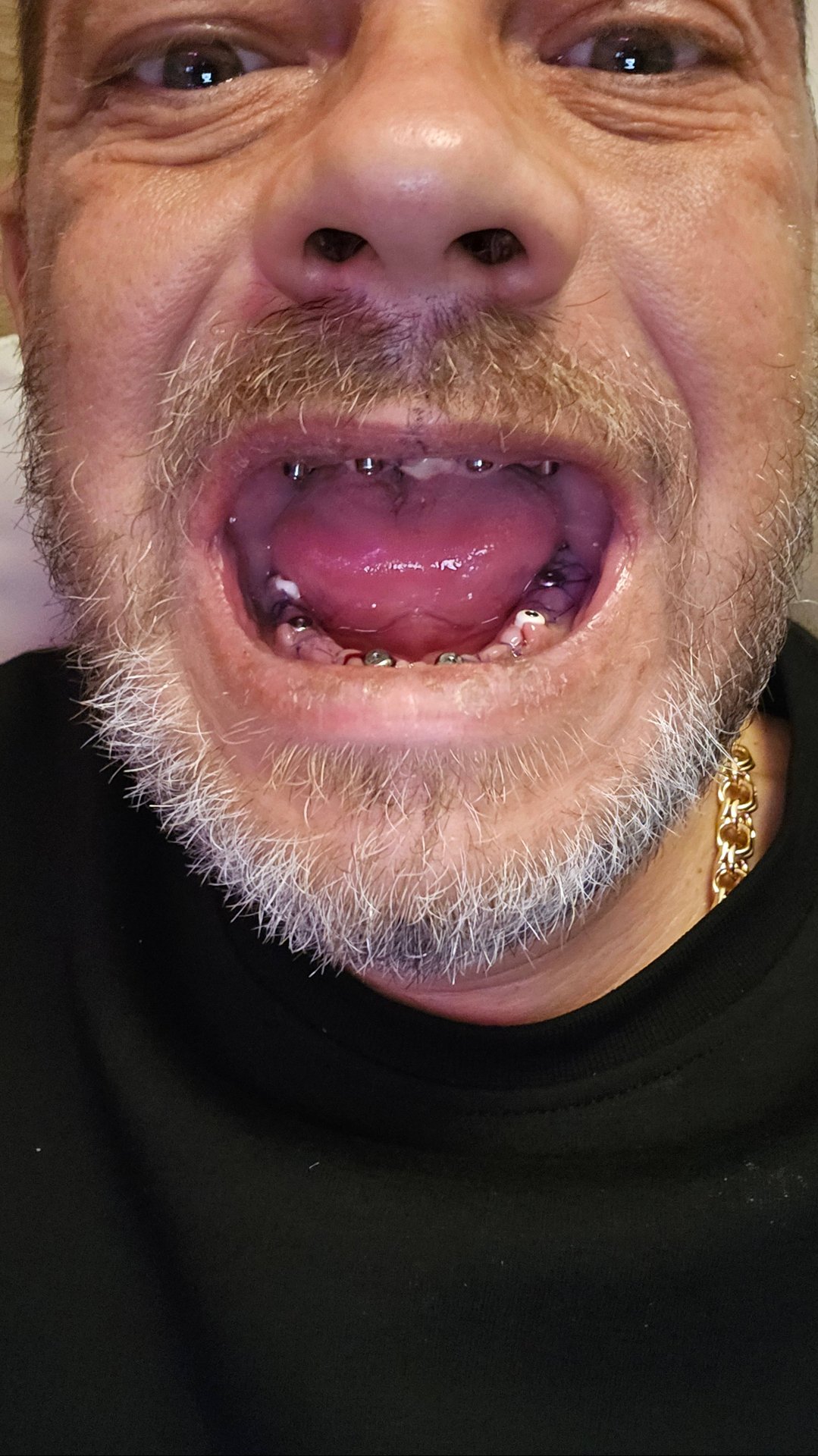 72 ЧАСА ПОСЛЕ УСТАНОВКИ ИМПЛАНТОВ