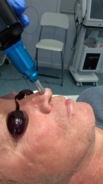 Удаление сосудов на носу