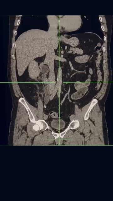 Опухоль правого мочеточника на снимках КТ