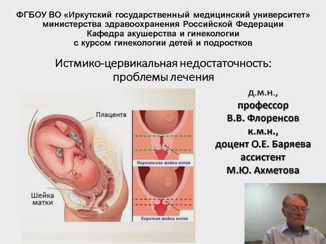 3. Истмико-цервикальная недостаточность: проблемы лечения