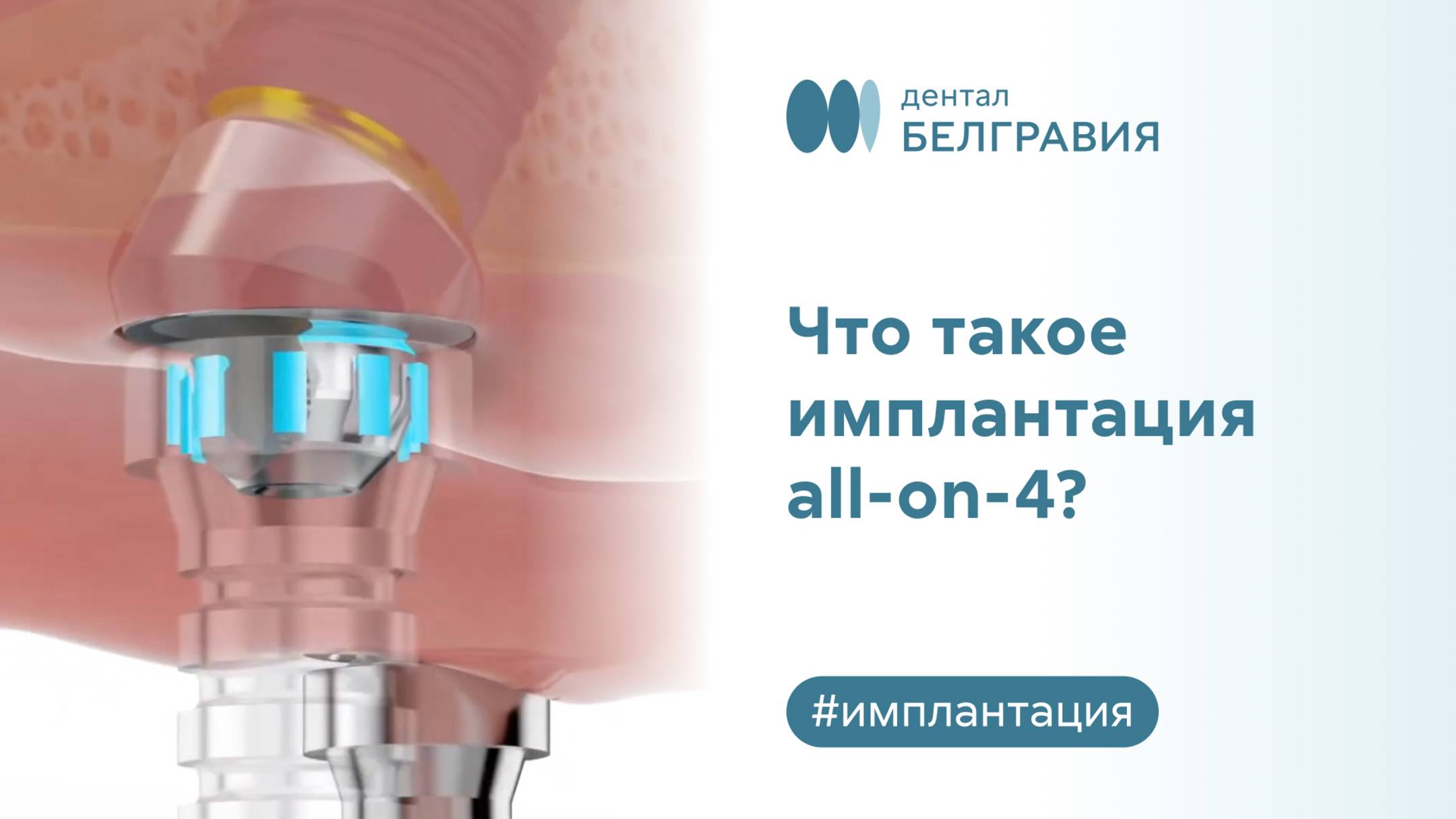Что такое имплантация all-on-4?