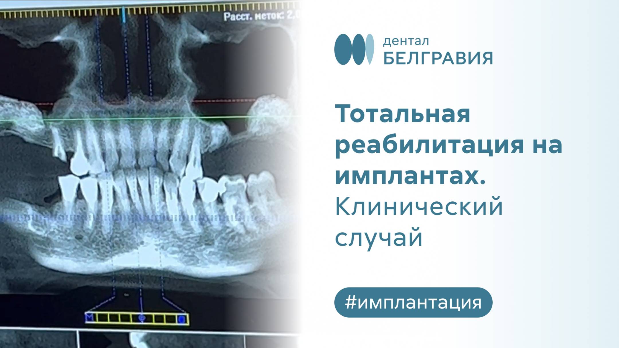 Тотальная реабилитация на имплантах. Клинический случай
