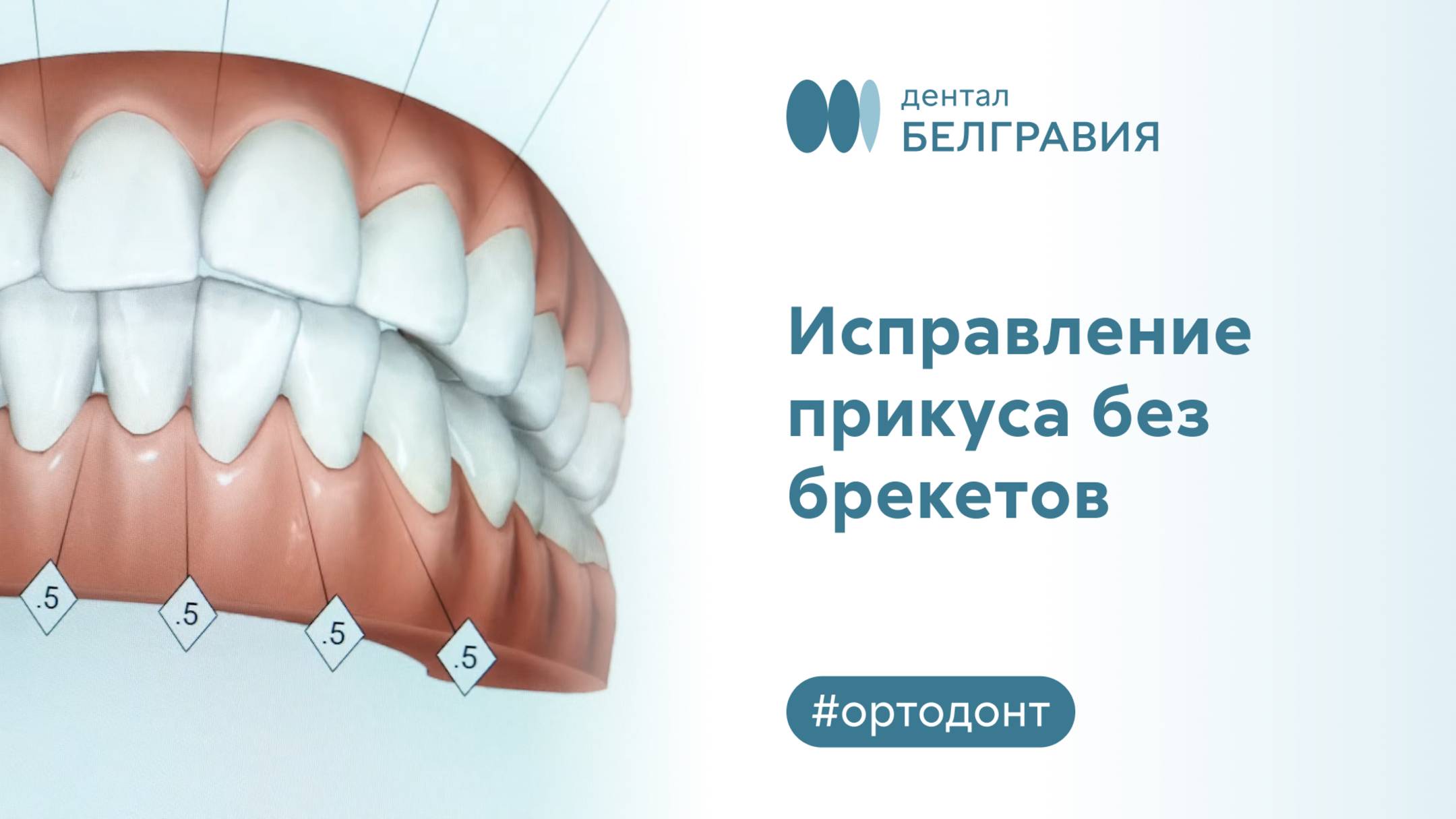 ✅ Исправление прикуса без брекетов