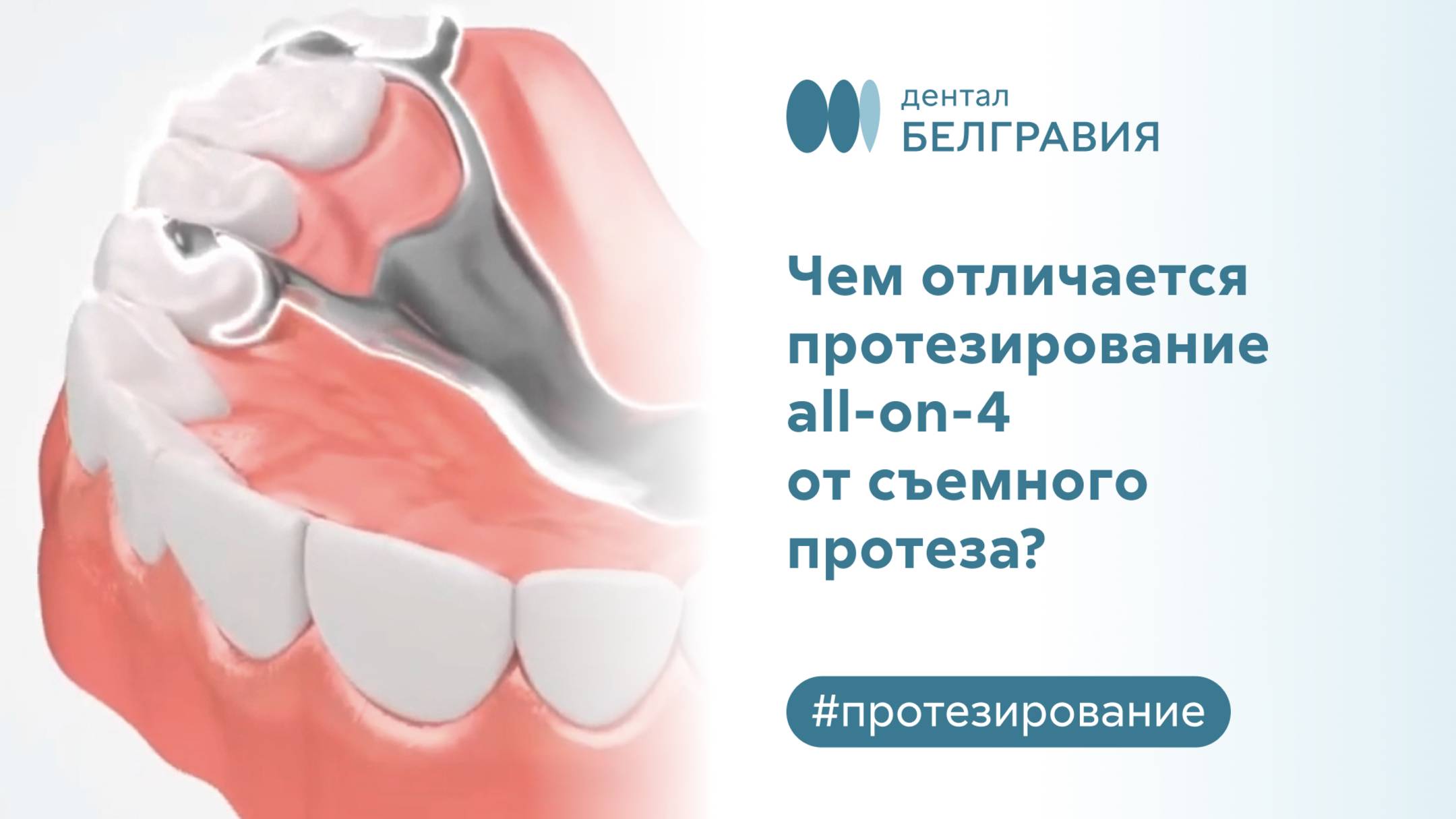 Чем отличается протезирование all-on-4 от съемного протеза?