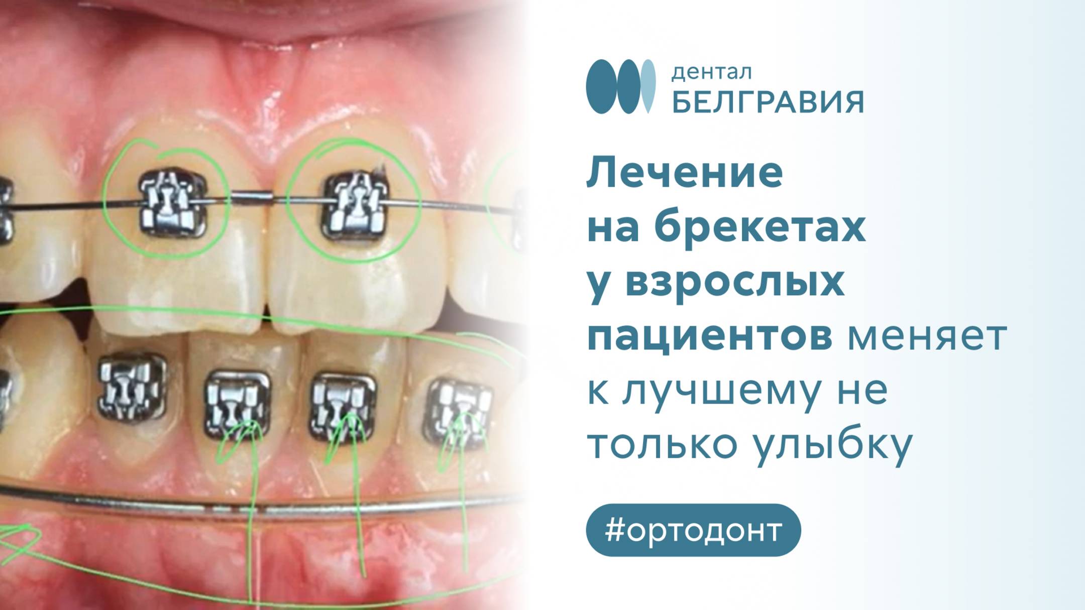 У взрослых пациентов лечение на брекетах меняет к лучшему не только улыбку