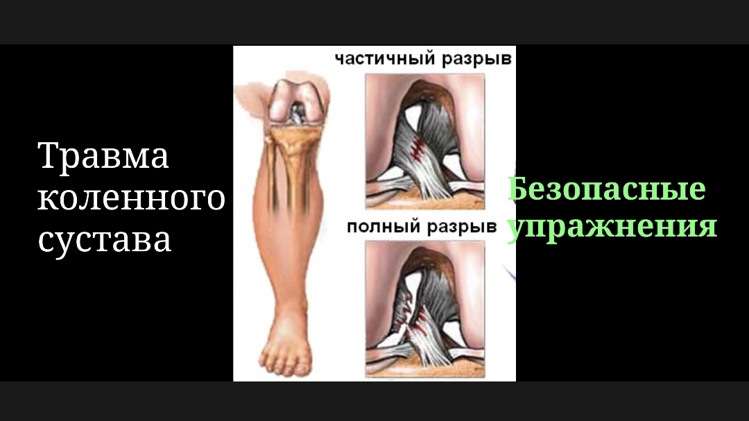 Безопасные и полезные упражнения при травме коленного сустава