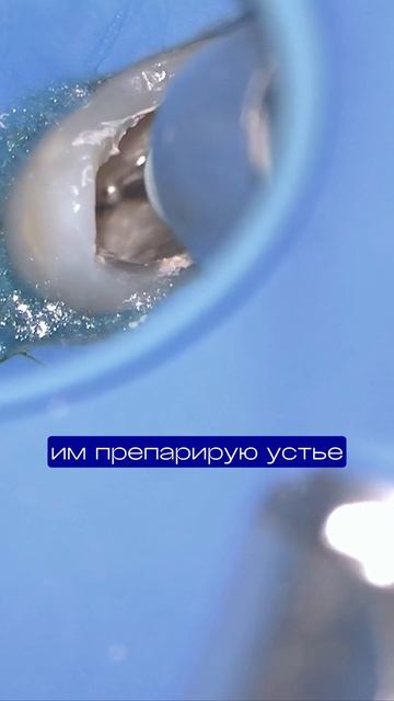 Первый этап повторного лечения каналов #стоматология #эндодонтия #канал #корневойканал #пульпит