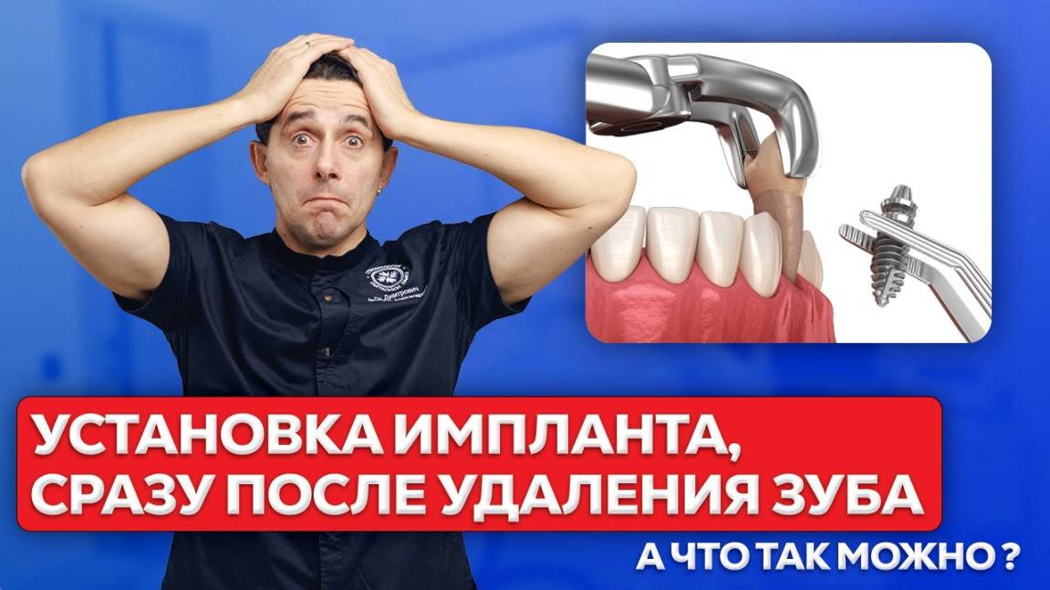 Установка импланта сразу после удаления зуба. А что, так можно?