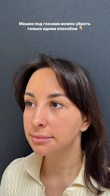 Как убрать мешки под глазами? ДО и ПОСЛЕ 🔥