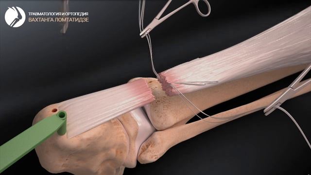 Разрыв ахилла  Закрытый шов ахиллова сухожилия