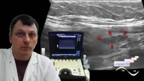 Детское УЗИ щитовидной железы - Тирадс 5