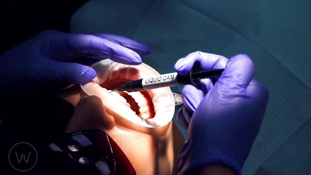 В чем секрет белоснежной улыбки? Отбеливающие полоски White Secret