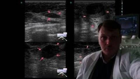 Ультразвуковая диагностика молочных желез - Образования молочных желез БИ-РАДС 2-3