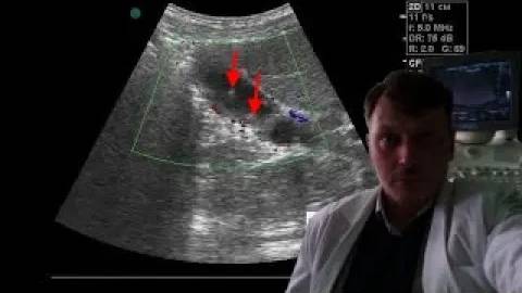 УЗИ брюшной полости - Полипоз желчного пузыря