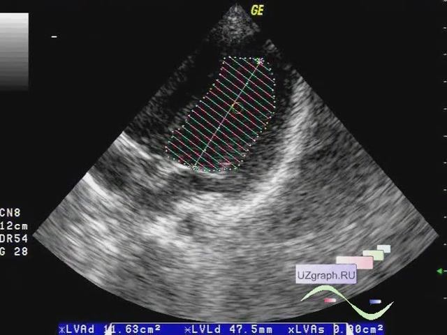 Мини-Лекция: ЭхоКГ - Базовый Уровень плюс. Измерение Фракции выброса по Симпсону