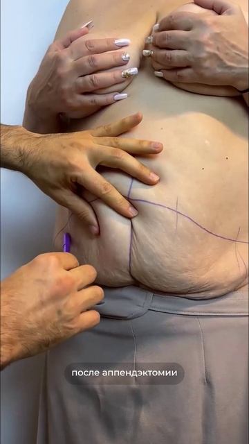 ВЫПОЛНЕН КОМПЛЕКС ОПЕРАЦИЙ НА ЛИЦЕ И ТЕЛЕ. Часть 1. Доктор Карапетян