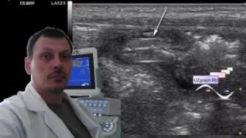 Детское УЗИ кишечника - Аскарида на УЗИ