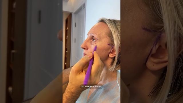 ВЫПОЛНЕН КОМПЛЕКС ТОТАЛ ФЭЙС ДЛЯ ИНОГОРОДНЕЙ ПАЦИЕНТКИ. Доктор Карапетян