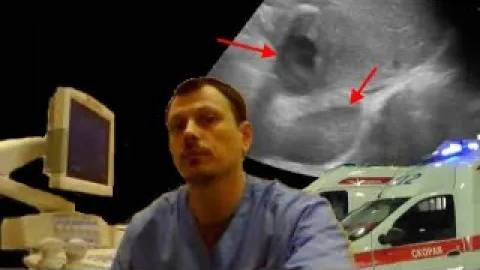 Детское УЗИ брюшной полости -  Псевдоопухоль печени