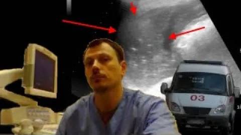 Детское УЗИ легких - Пневмония на УЗИ