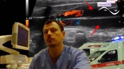 Детское УЗИ сосудов (УЗДГ) -  Флебэктазия и удвоение внутренней яремной вены