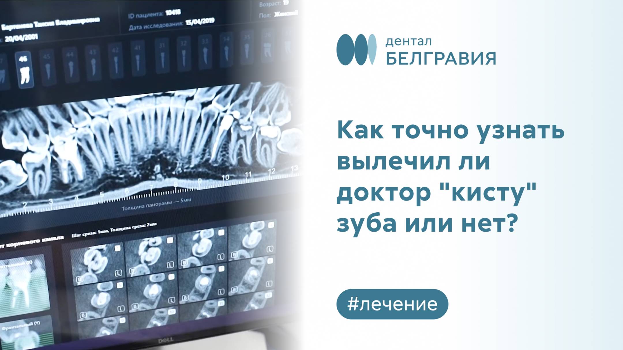 Как точно узнать вылечил ли доктор "кисту" зуба или нет?