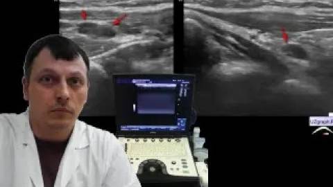 Детское УЗИ щитовидной железы - Диффузно-очаговые изменения щитовидной, аденомы паращитовидных желез