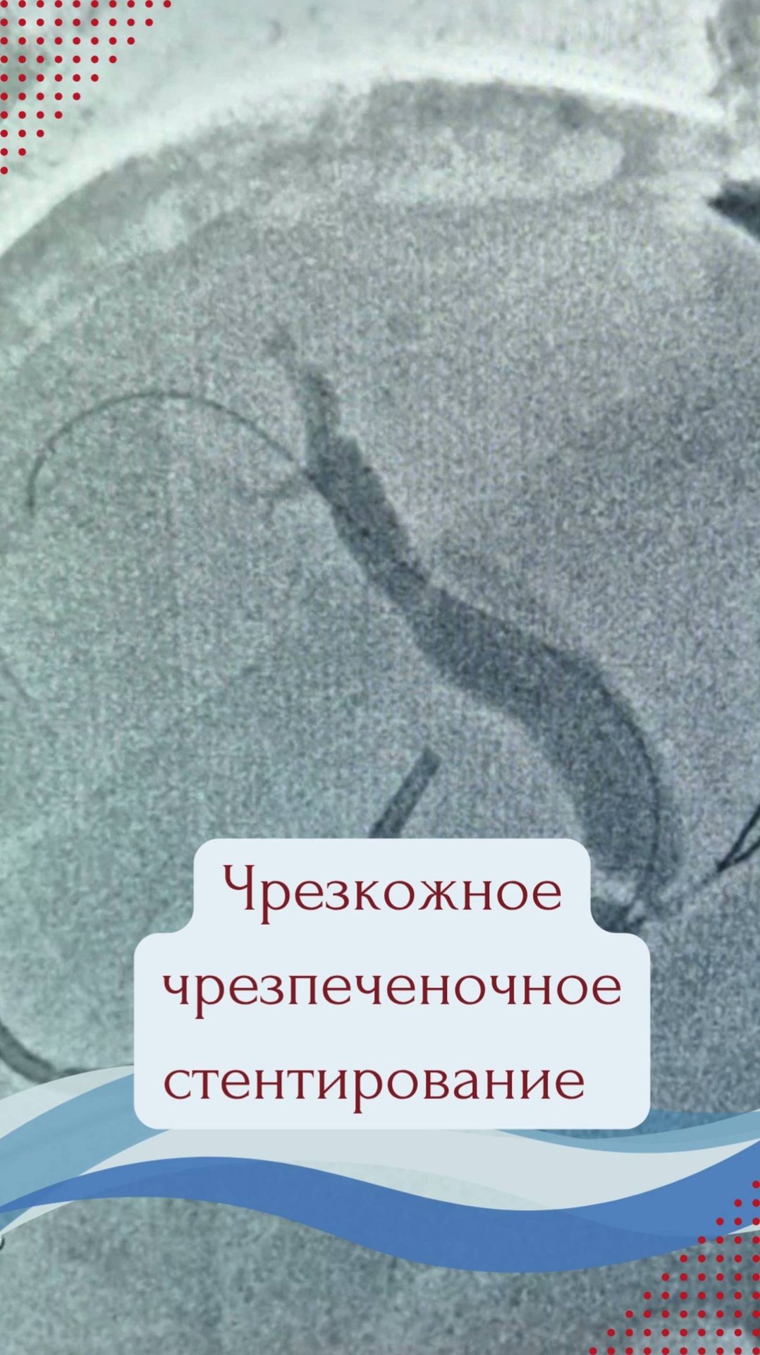 Чрескожное чрезпечёночное билиарное стентирование