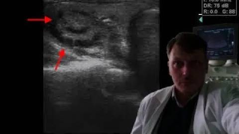 УЗИ щитовидной железы - Большой кистозно-солидный узел щитовидной железы