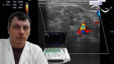 Детское УЗИ сосудов / УЗДГ БЦА - Гипоплазия позвоночной артерии