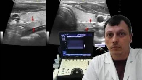 Детское УЗИ щитовидной железы - Добавочная доля щитовидной железы