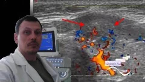 Детское УЗИ щитовидной железы - Папиллярный рак щитовидной железы