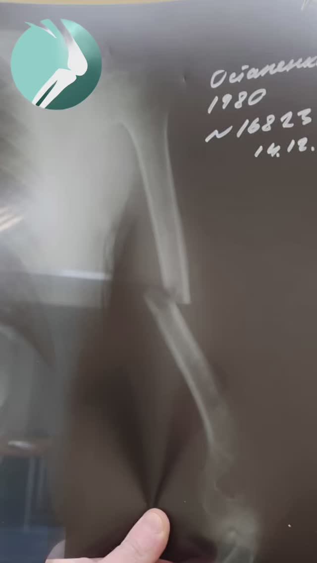 Остеосинтез при травме - переломе плеча. ЛД Медицина 8 926 520 21 26