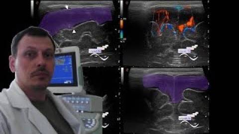 Нейросонография - Субконвекситальная жидкость