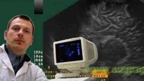 Нейросонография (УЗИ головного мозга) - Дисгенезия мозолистого тела