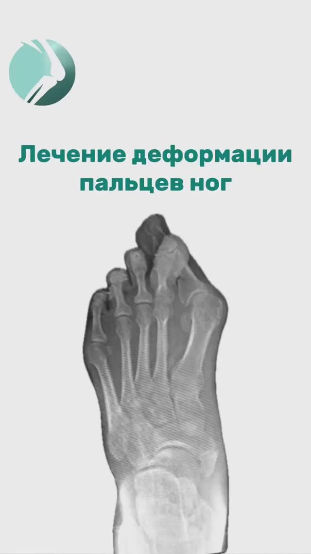 Деформация пальцев ног, лечение. ЛД Медицина