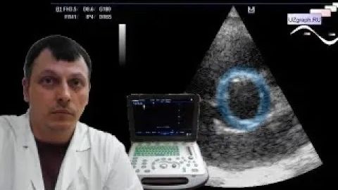 Детское УЗИ сердца (эхокардиография) - Двустворчатый/бикуспидальный аортальный клапан