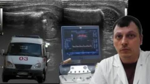 Детское УЗИ плечевого сустава -  Эпифизарный остеомиелит плеча на УЗИ