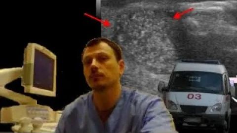 Детское УЗИ мошонки - Каменные яйца (микролитиаз)