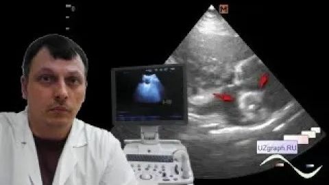 Детская Эхокардиография - Окклюдер типа Амплатцер