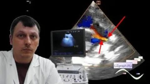 Детская Эхокардиография (УЗИ) - Открытый артериальный проток (ОАП) / Боталлов проток