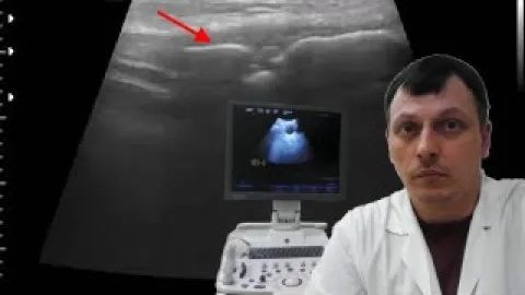 Детское УЗИ коленных суставов - Болезнь Осгуда-Шляттера