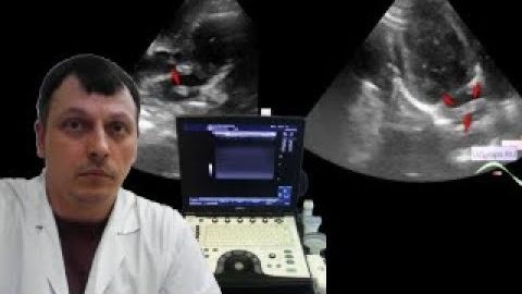 Детское УЗИ сердца (эхокардиография) -  Гиперэхогенная линейная структура в левом предсердии