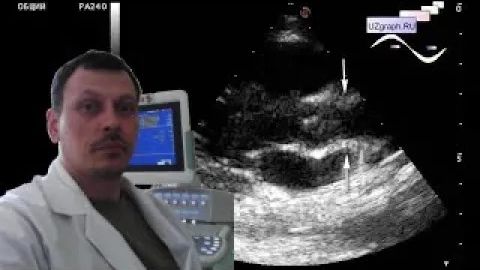 Детское УЗИ сердца (эхокардиография) -  Надклапанный аортальный стеноз