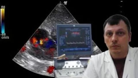 Детская Эхокардиография - Открытое овальное окно