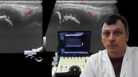 Детское УЗИ коленных суставов - Зоны пониженной эхогенности в проекции менисков