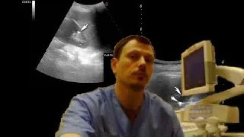 Детское УЗИ почек - Абдоминальная колика